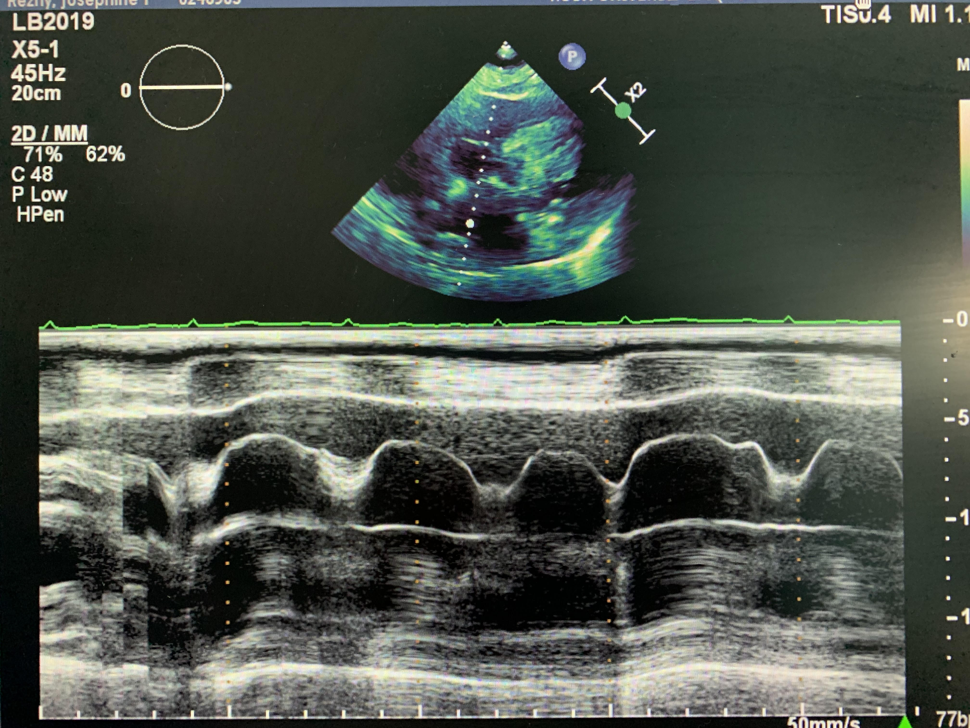 Diastolic Collapse of Right Atrium – Echo Lab and Boards Review