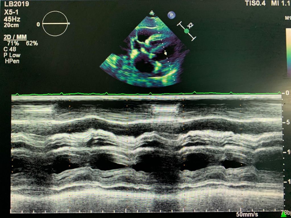 Diastolic Collapse of Right Atrium – Echo Lab and Boards Review