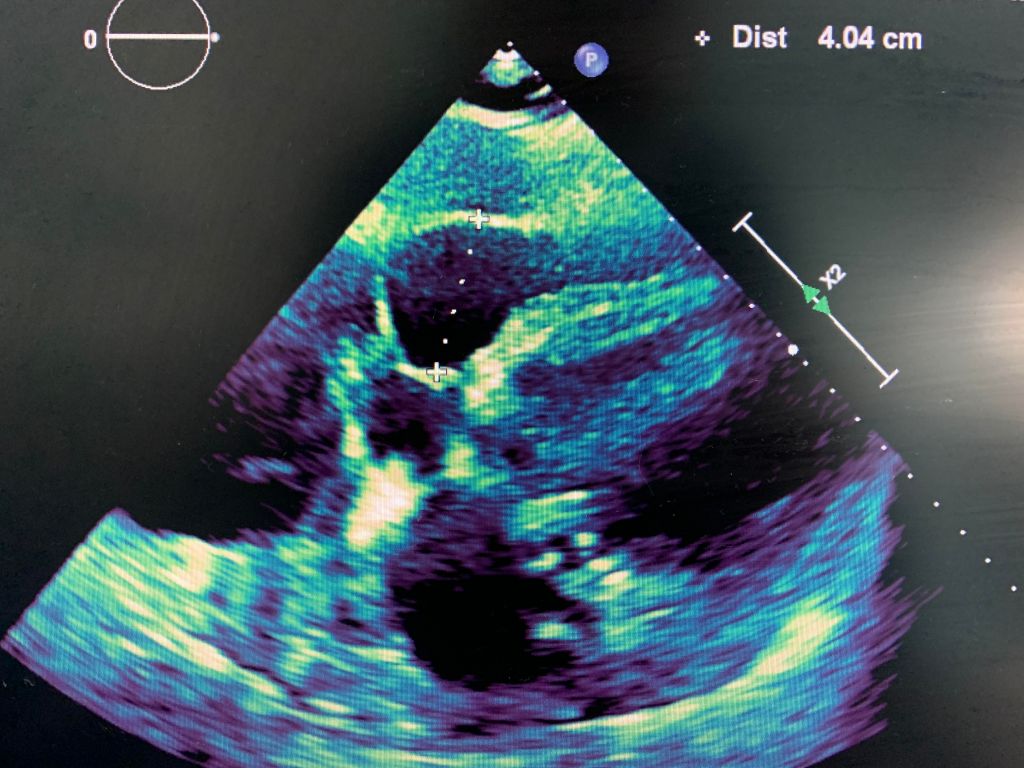 Diastolic Collapse of Right Atrium – Echo Lab and Boards Review